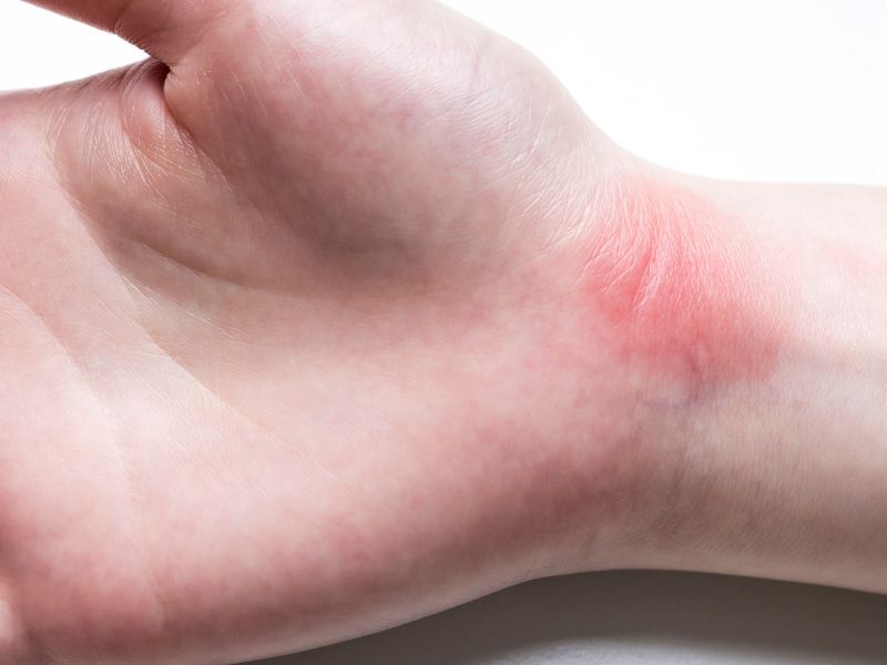 Dealing with Tendonitis in the Wrist - The Velvet Runway